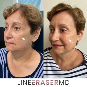 Cheek Lift: Botox as Non-Surgical Option | Medica Depot