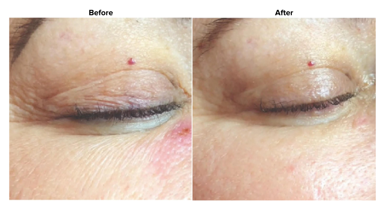 Biorepeel Before & After: Unlock Radiant Skin | Medica Depot