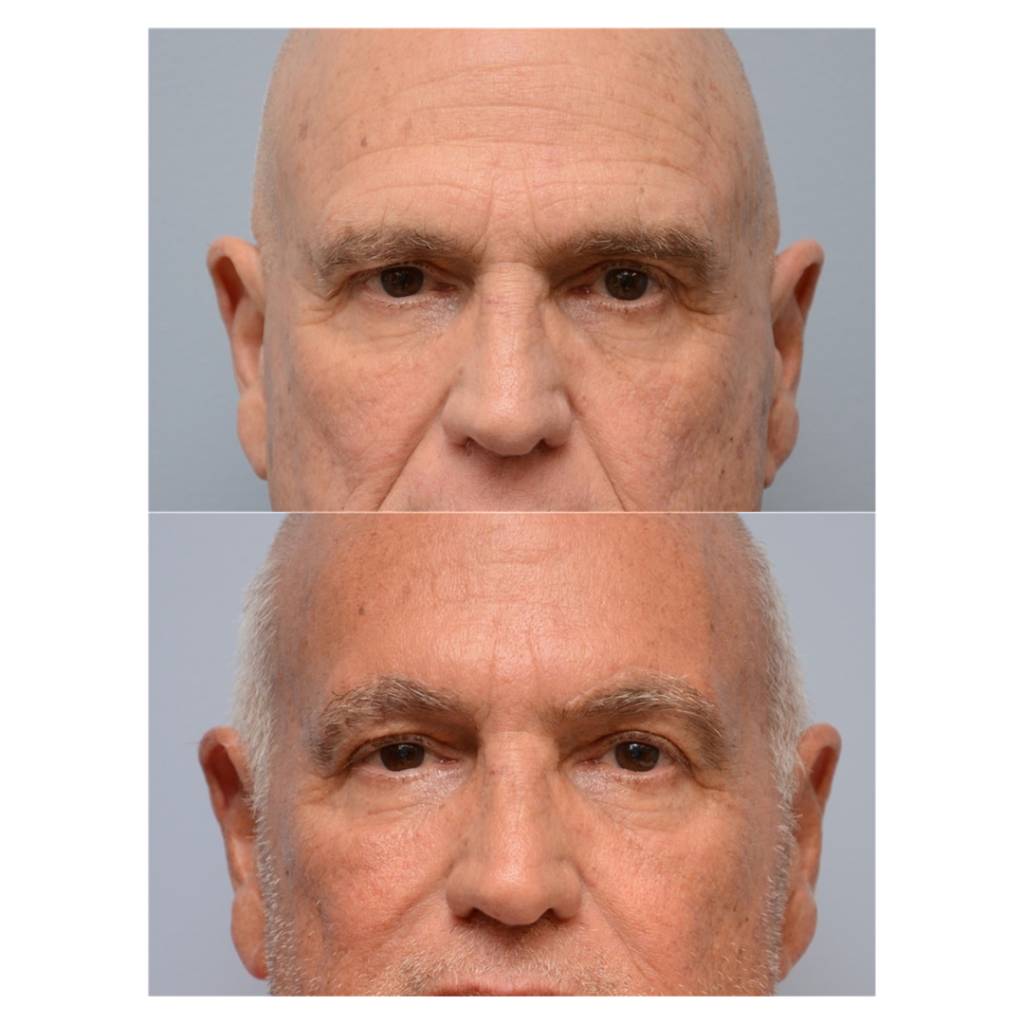 Cheek Lift: Botox as Non-Surgical Option | Medica Depot